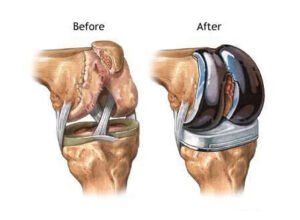 Knee Replacement - Sanjivani Hospital